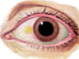 Occular Lesions Precision Cataract Surgery, St Augustine Trinidad West ...